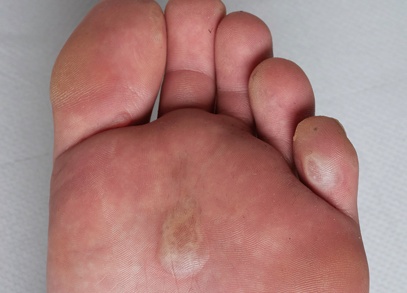 Epidermolysis bullosa: understanding the clinical features ...