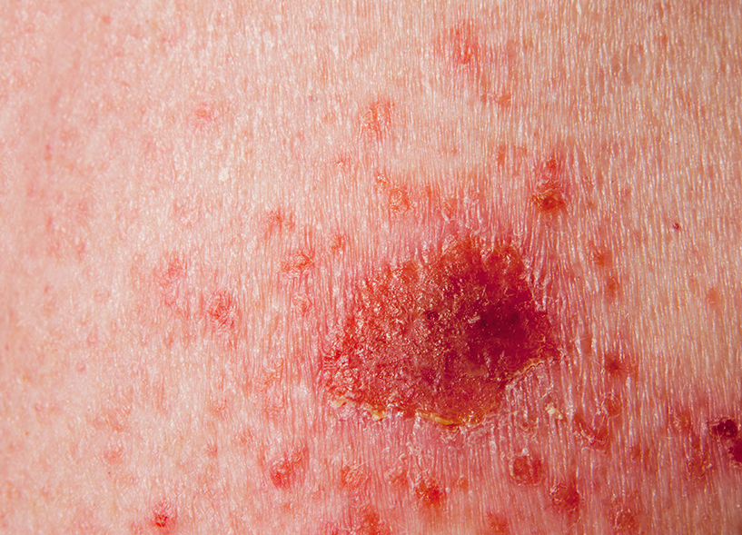 Non-surgical management of non-melanoma skin cancers - Dermatology in ...