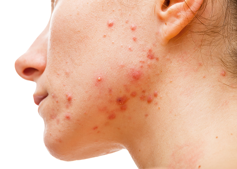 What I tell my patients about… acne - Dermatology in practice