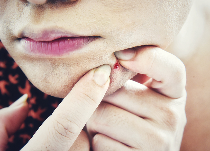 Acne excoriée - Dermatology in practice