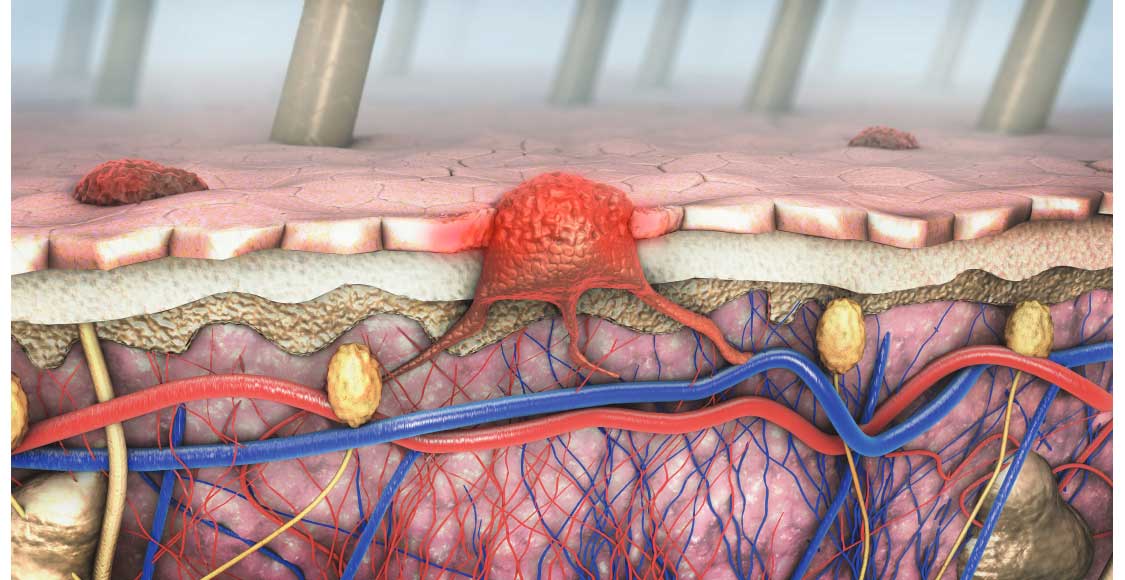 Clinical management of advanced skin cancer - Dermatology in practice