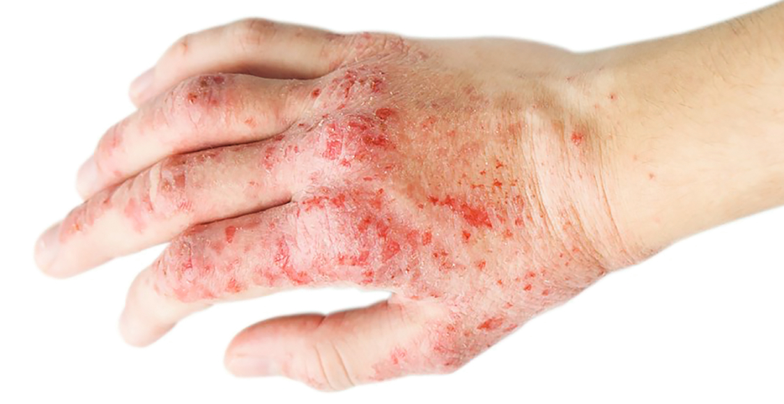 Unmasking the true impact of eczema: A call to action for collaboration ...