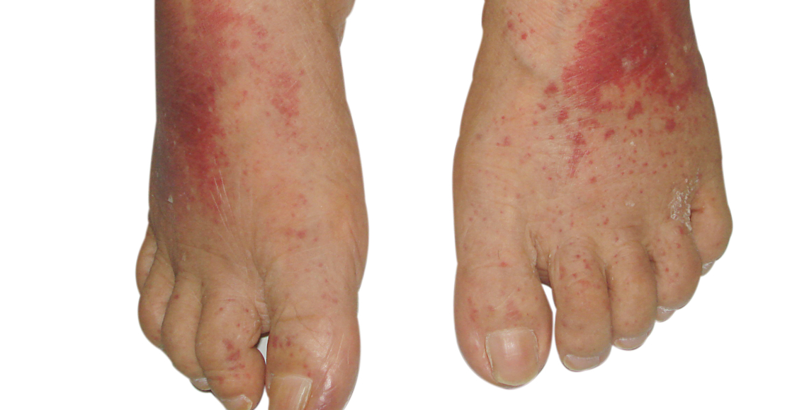 What I tell my patients about…Vasculitis - Dermatology in practice