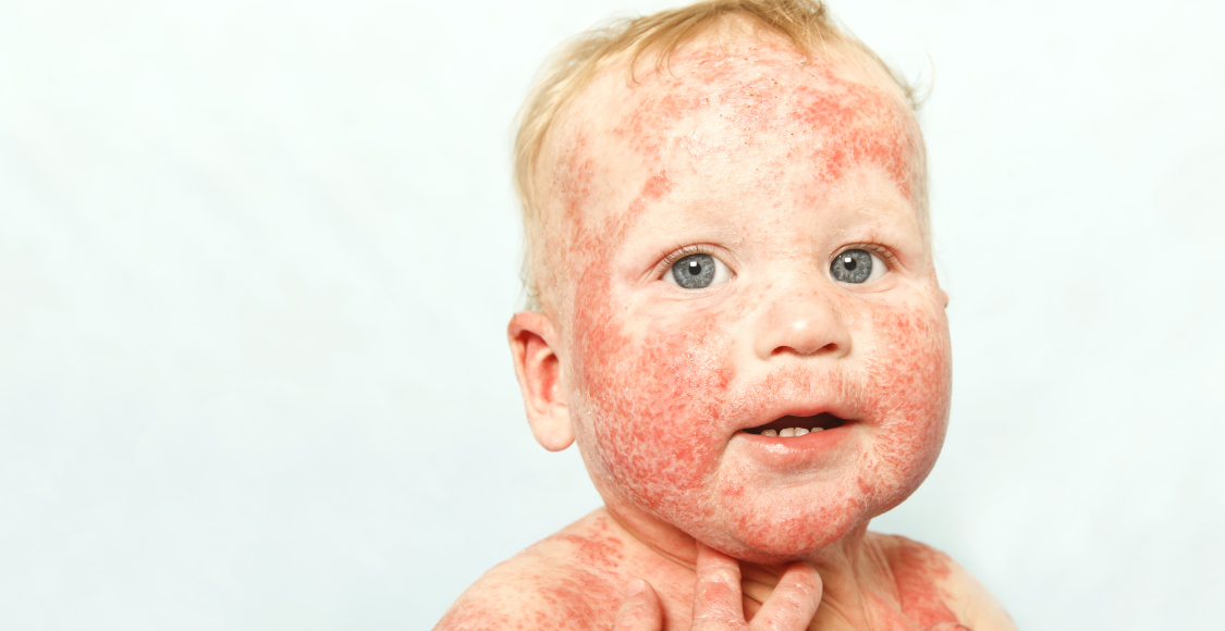 Can prophylactic emollients prevent the development of atopic ...