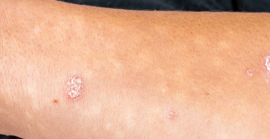 Inflammatory skin diseases: dermatological treatments for psoriasis ...
