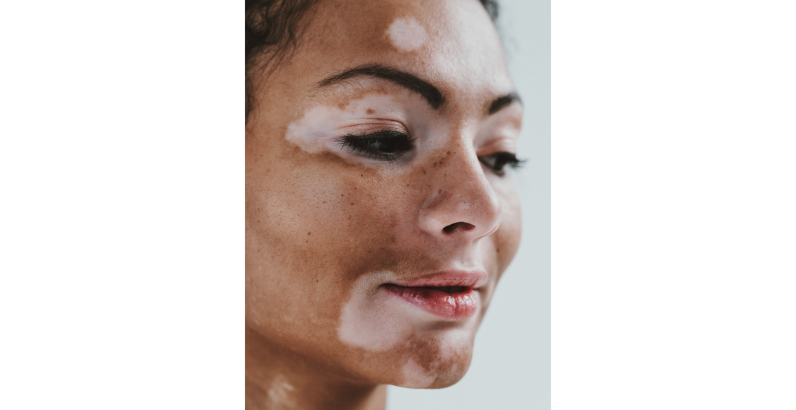 The mental health impact of skin disorders - Dermatology in practice